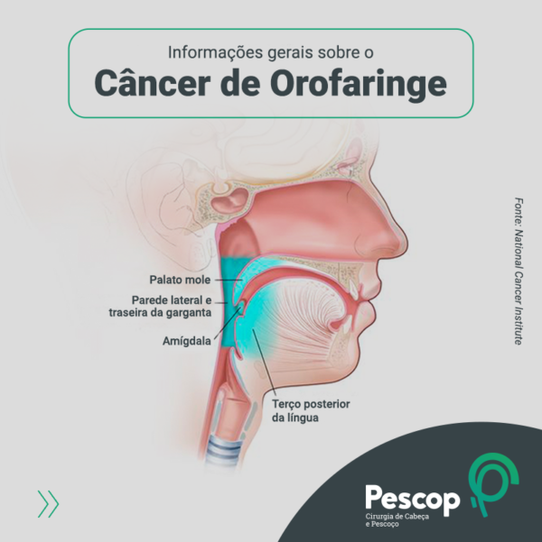 Informações gerais sobre o Câncer de Orofaringe - Pescop